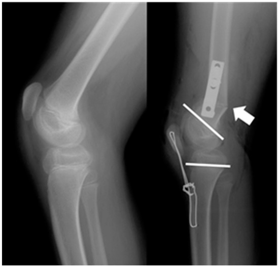 Distal Femoral Shortening Osteotomy for Severe Knee Flexion Contracture ...