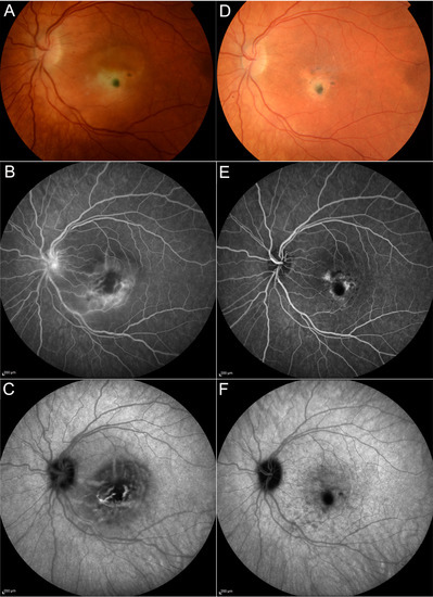 The Eye as a Window to Systemic Infectious Diseases: Old Enemies, New ...