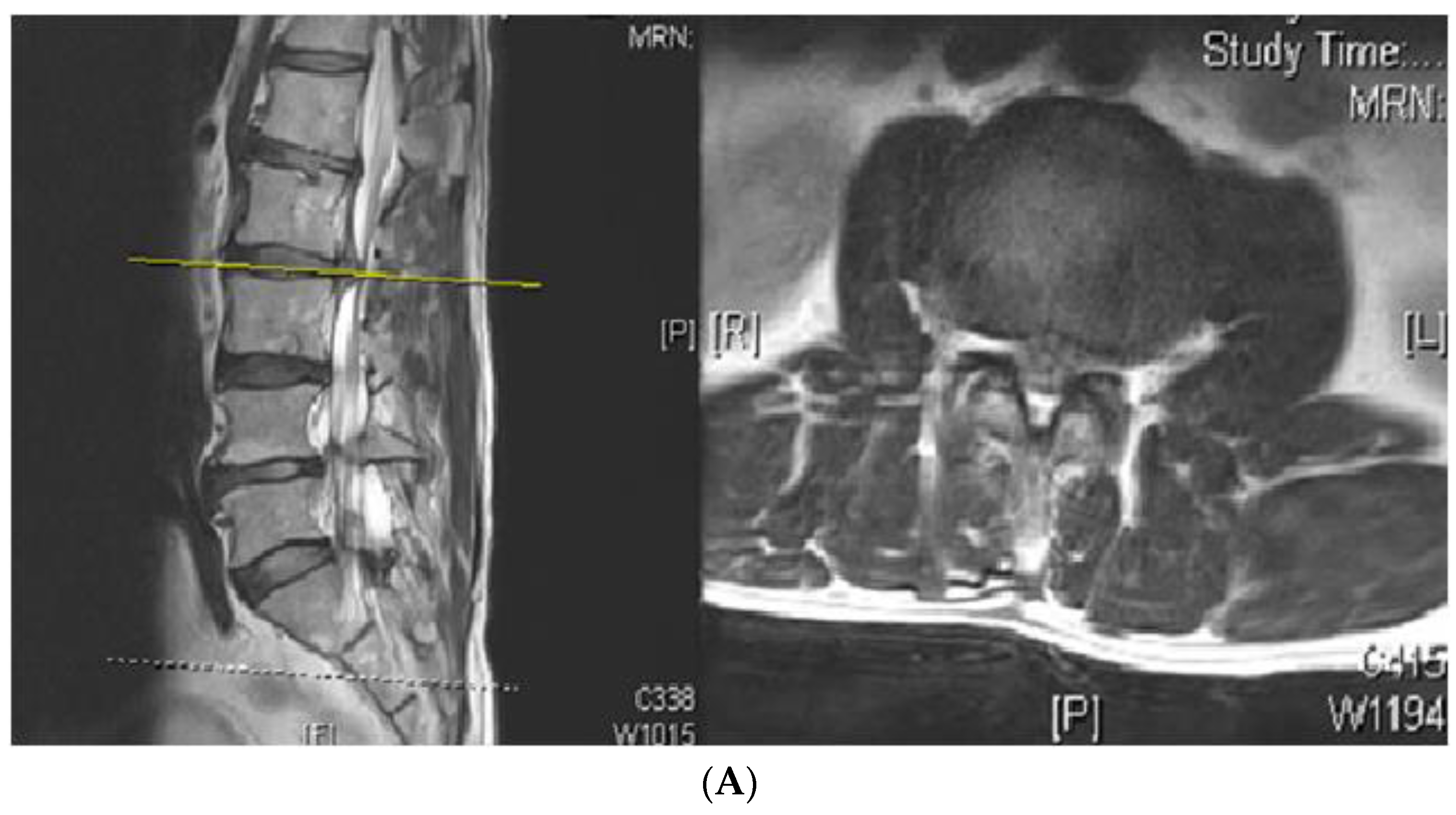 Surgical Outcomes for Upper Lumbar Disc Herniation: Decompression Alone ...