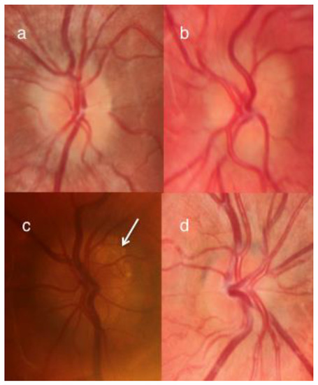 Detection of Optic Disc Drusen in Children Using Ultrasound through the ...