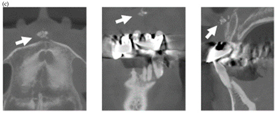 Multiple External Root Resorption of Teeth as a New Manifestation of ...