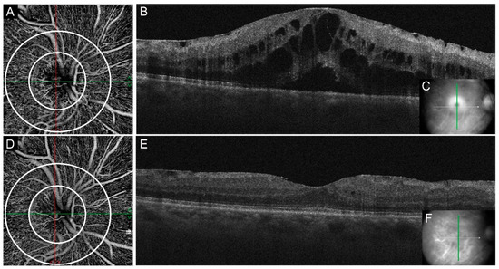 Papillary Vessel Density Changes after Intravitreal Anti-VEGF ...
