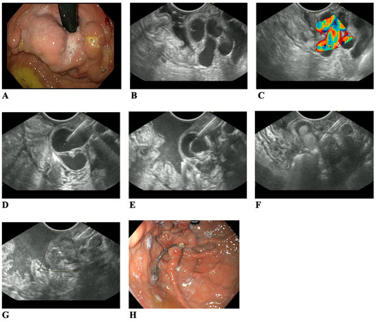 Endoscopic Ultrasound-Guided Treatment of Gastric Varices Using Coils ...