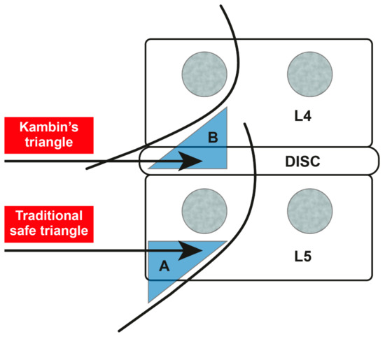 Kambin’s Triangle Approach versus Traditional Safe Triangle Approach ...