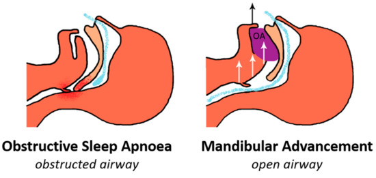 Oral Appliance Therapy for Obstructive Sleep Apnoea: State of the Art