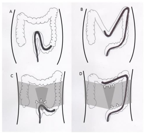 Effects of Encircled Abdominal Compression Device in Colonoscopy: A ...