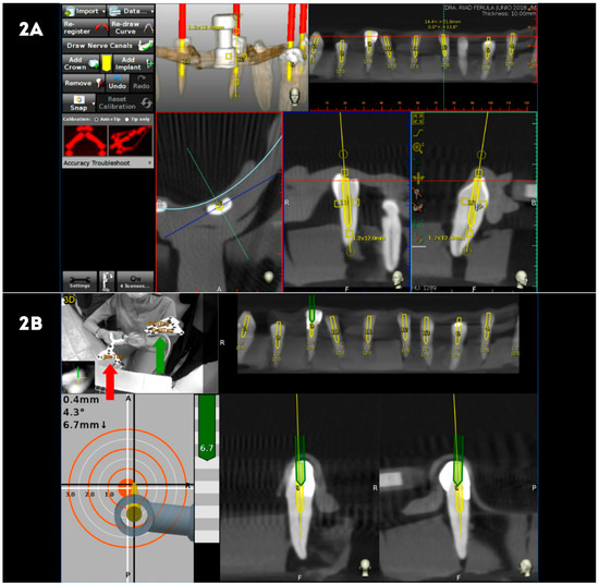 Accuracy Of Computer Aided Dynamic Navigation Compared To Computer Aided Static Procedure For