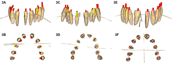 Accuracy of Computer-Aided Dynamic Navigation Compared to Computer ...