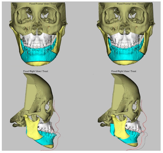 Effect of Le Fort I Maxillary Advancement and Clockwise Rotation on the ...