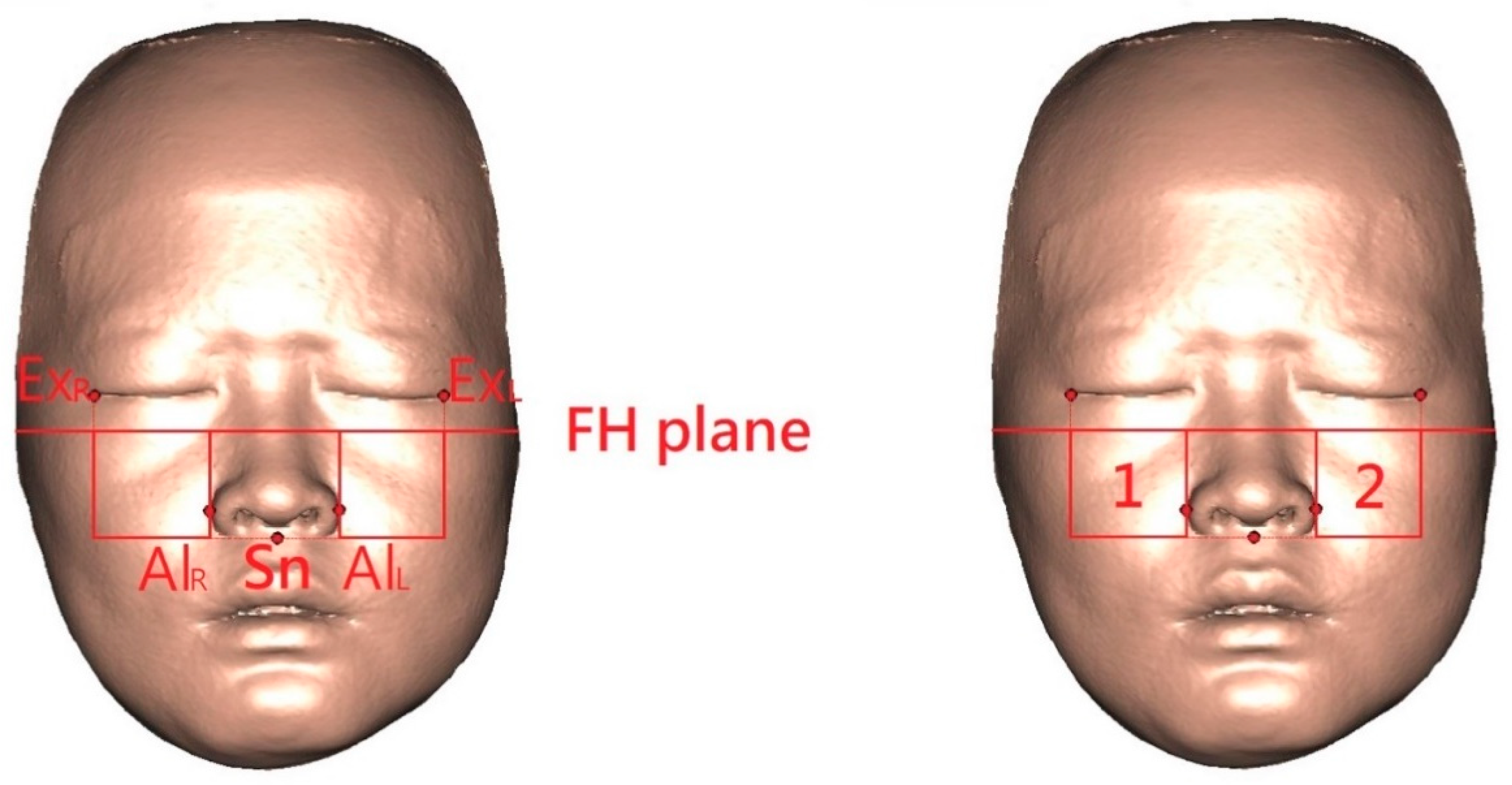 Effect of Le Fort I Maxillary Advancement and Clockwise Rotation on the ...