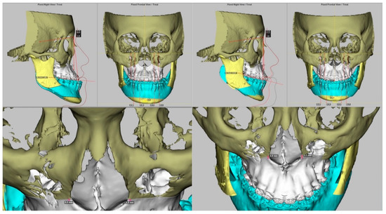 Effect of Le Fort I Maxillary Advancement and Clockwise Rotation on the ...