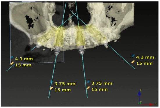 The Workflow of a New Dynamic Navigation System for the Insertion of Dental Implants in the ...