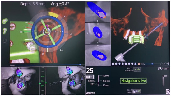 The Workflow of a New Dynamic Navigation System for the Insertion of ...