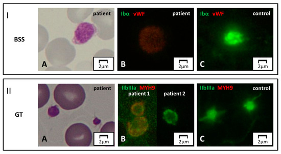 Diagnosis of Inherited Platelet Disorders on a Blood Smear