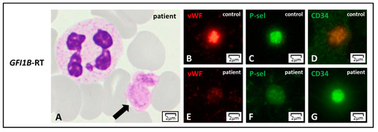Diagnosis of Inherited Platelet Disorders on a Blood Smear
