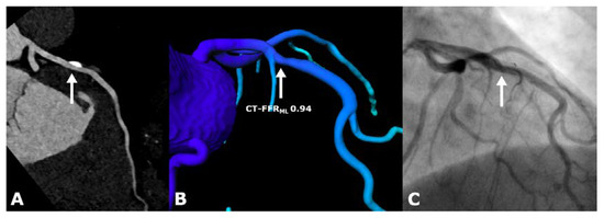 JCM | Free Full-Text | Additional Value of Machine-Learning Computed ...