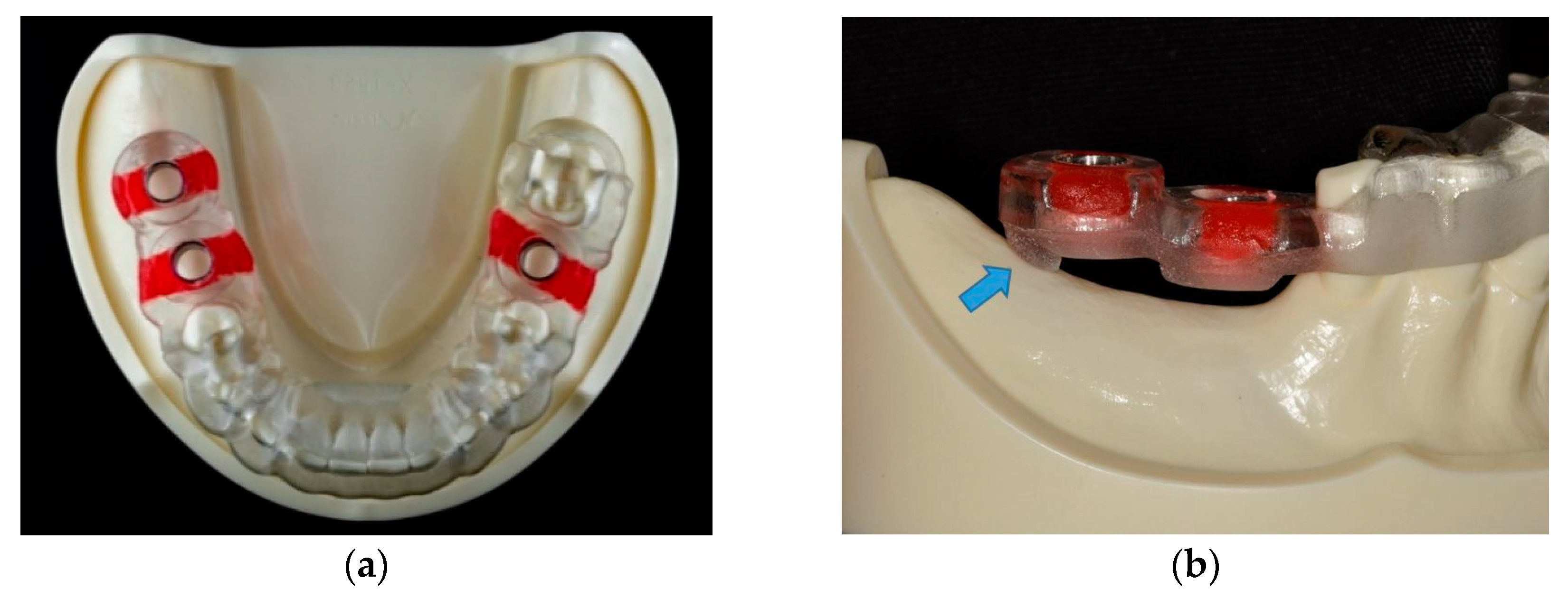 Stereolithographic Surgical Guide with a Combination of Tooth and Bone ...