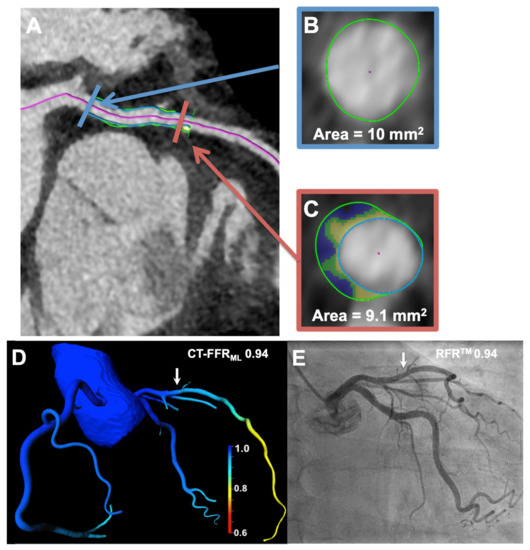 Comparison of Machine Learning Computed Tomography-Based Fractional Flow Reserve and Coronary CT ...