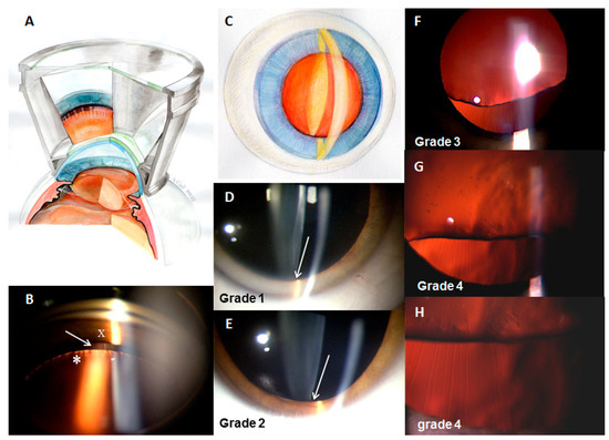 Classifying Ectopia Lentis in Marfan Syndrome into Five Grades of ...