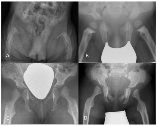 Hip Morphology in Mucolipidosis Type II