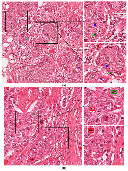 Artificial Intelligence-Based Mitosis Detection in Breast Cancer Histopathology Images Using ...