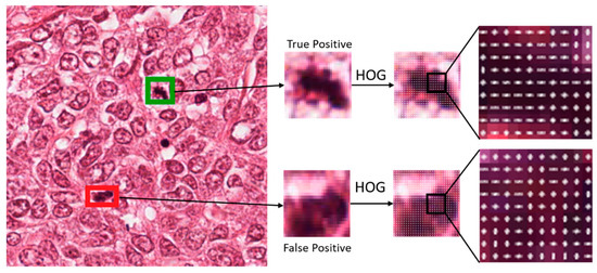 Artificial Intelligence-Based Mitosis Detection in Breast Cancer ...