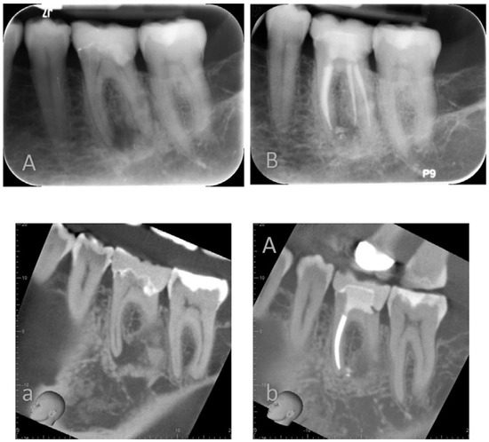 Outcome of Root Canal Treatments Using a New Calcium Silicate Root ...