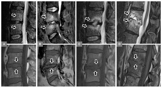 Vertebral Bone Marrow and Endplate Assessment on MR Imaging for the ...