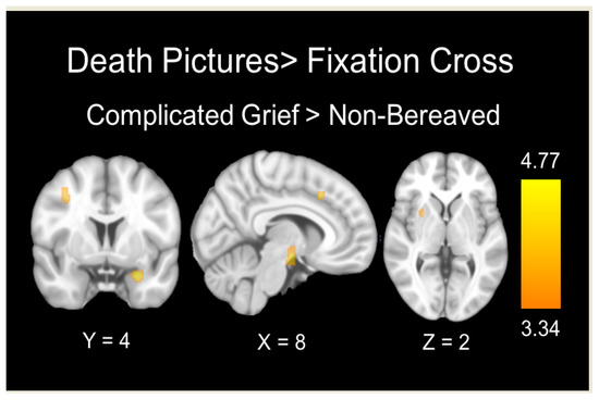 Increased Amygdala Activations during the Emotional Experience of Death ...