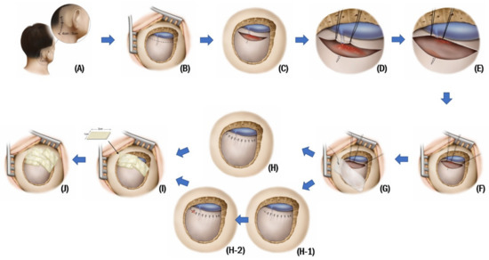 Microvascular Decompression Recovery Time