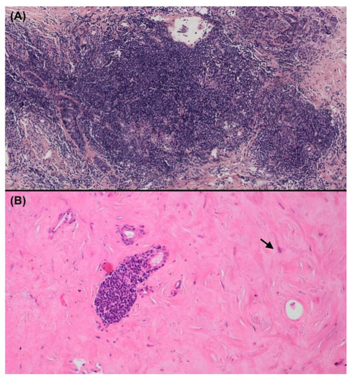 Mastitis in Autoimmune Diseases: Review of the Literature, Diagnostic ...