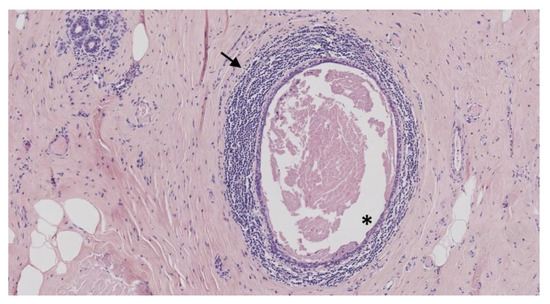 Mastitis in Autoimmune Diseases: Review of the Literature, Diagnostic ...