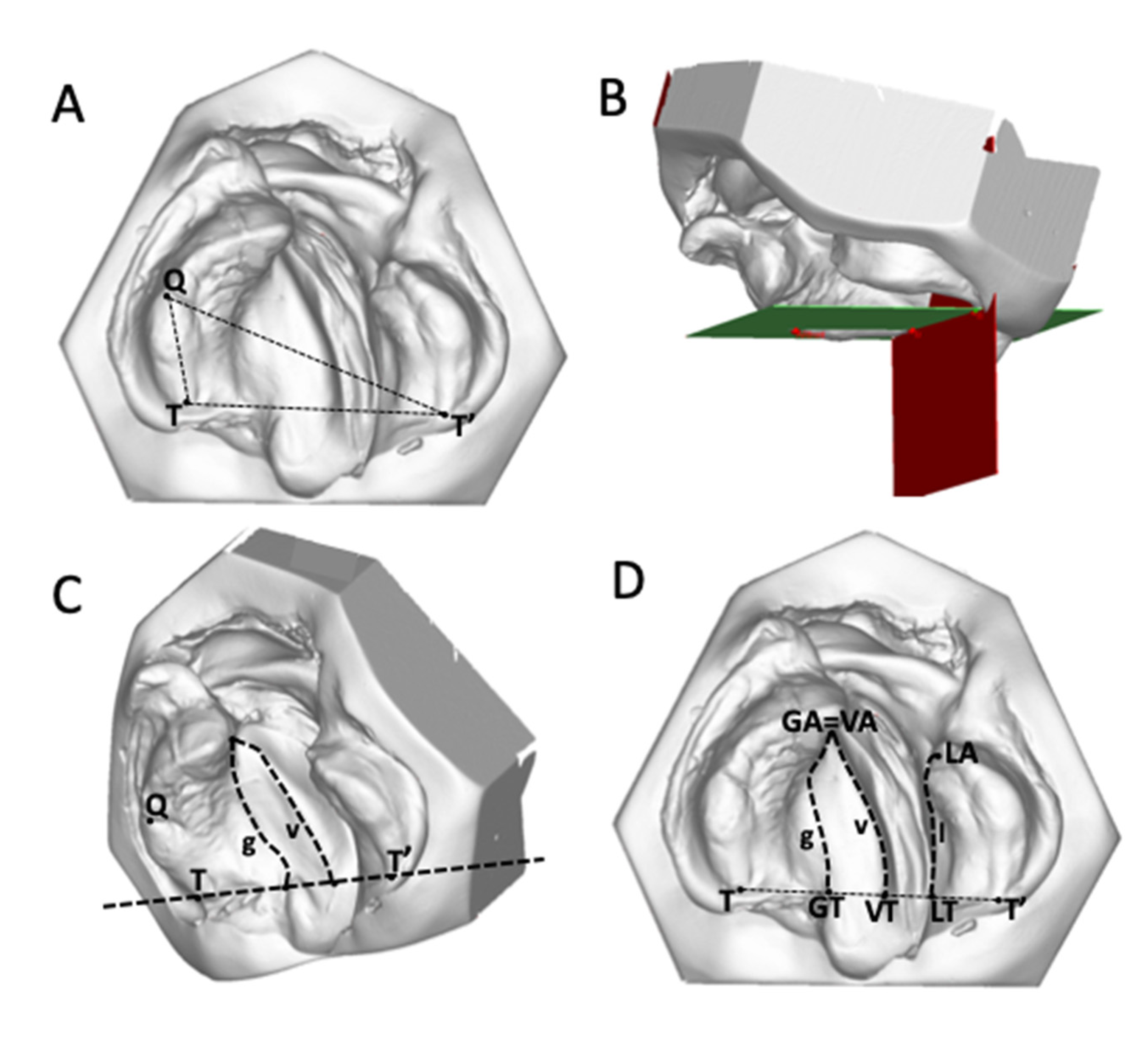 Three-Dimensional Morphological Changes of the True Cleft under Passive ...