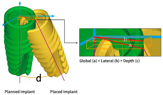 Fully Digital Workflow for Planning Static Guided Implant Surgery: A ...
