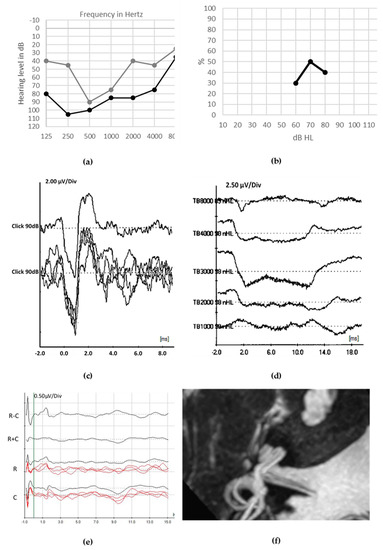 Auditory Neuropathy Spectrum Disorders: From Diagnosis to Treatment ...