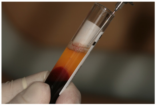Platelet Rich Fibrin (PRF) and Its Related Products: Biomolecular ...