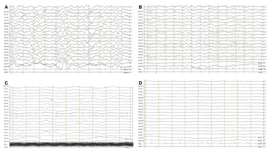 Normal Versus Abnormal Eeg