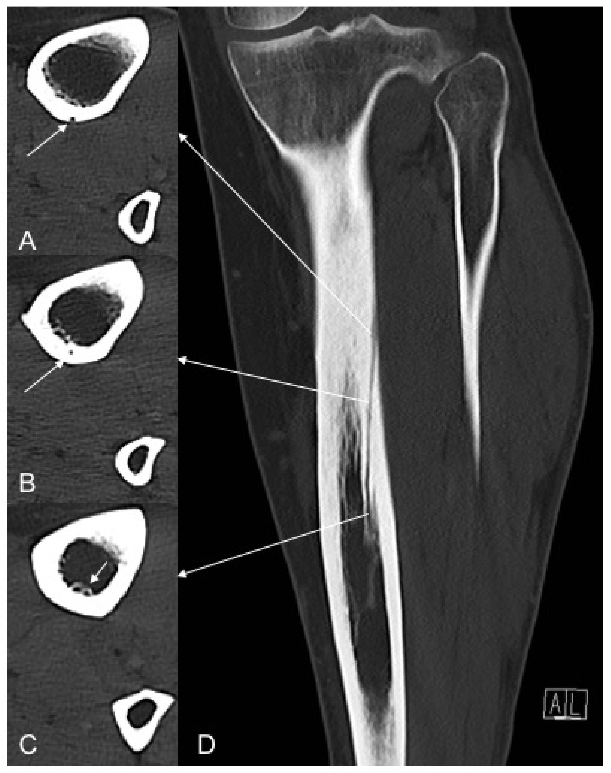 Nutrient Canal Radiograph