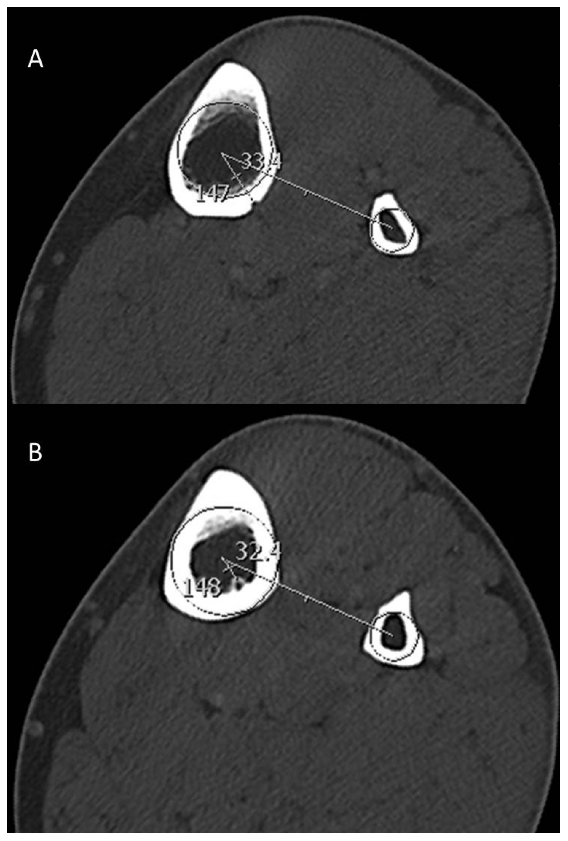 The Anatomy of the Tibial Nutrient Artery Canal—An Investigation of 106 ...