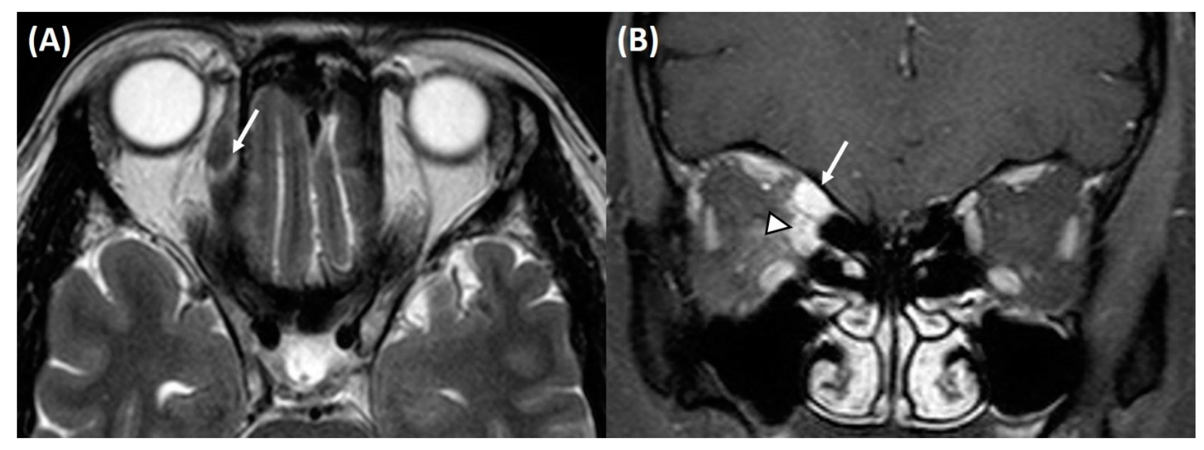 Clinical Features of Ocular Motility in Idiopathic Orbital Myositis