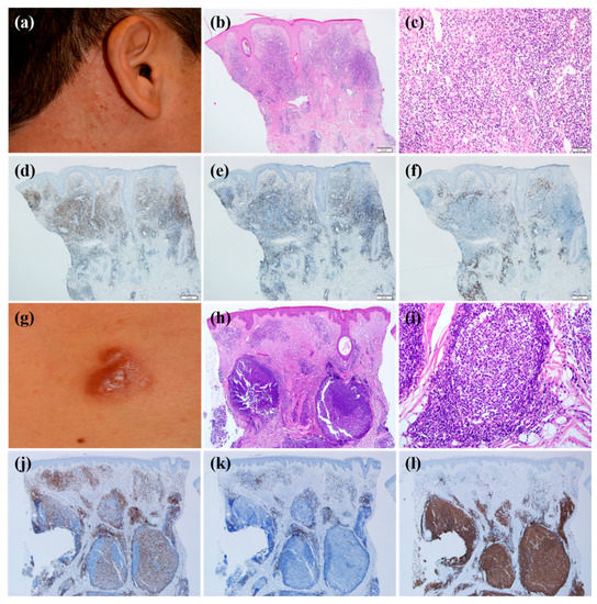 Clinical and Histopathological Characteristics of Cutaneous Lymphoid ...