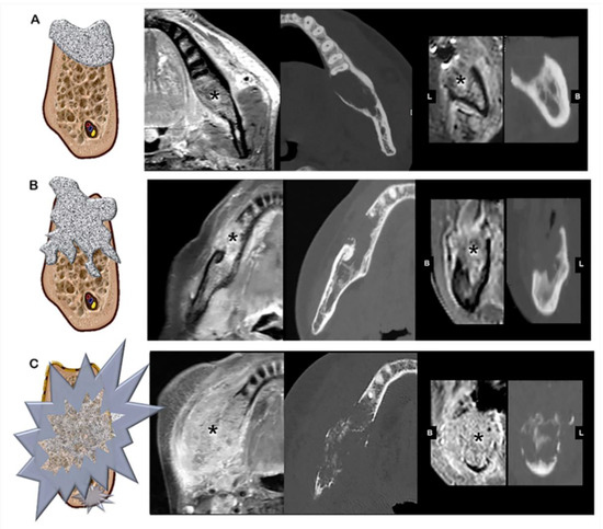 Prognostic Implications of Combined Imaging and Histologic Criteria in ...