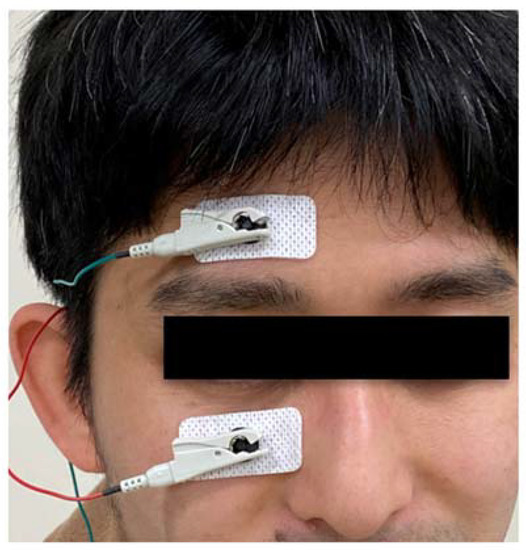 A Single-Arm, Prospective, Exploratory Study to Preliminarily Test ...