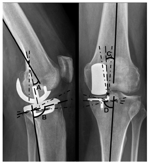 Cementless Oxford Medial Unicompartmental Knee Replacement—Clinical and ...