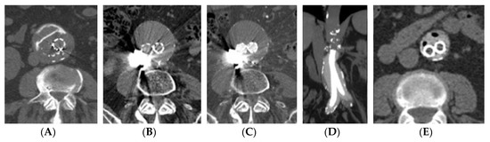 Imaging Modalities for the Diagnosis of Vascular Graft Infections: A ...