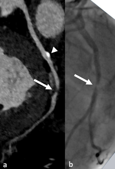 Combined Coronary CT-Angiography and TAVI-Planning: A Contrast-Neutral ...