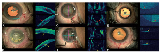 What Is the Impact of Intraoperative Microscope-Integrated OCT in ...