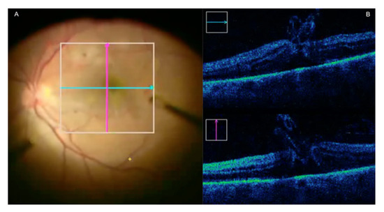What Is the Impact of Intraoperative Microscope-Integrated OCT in ...