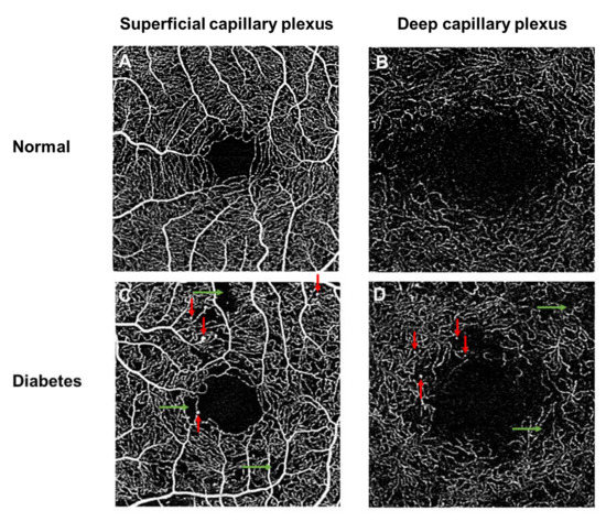 Optical Coherence Tomography Angiography in Diabetes and Diabetic ...