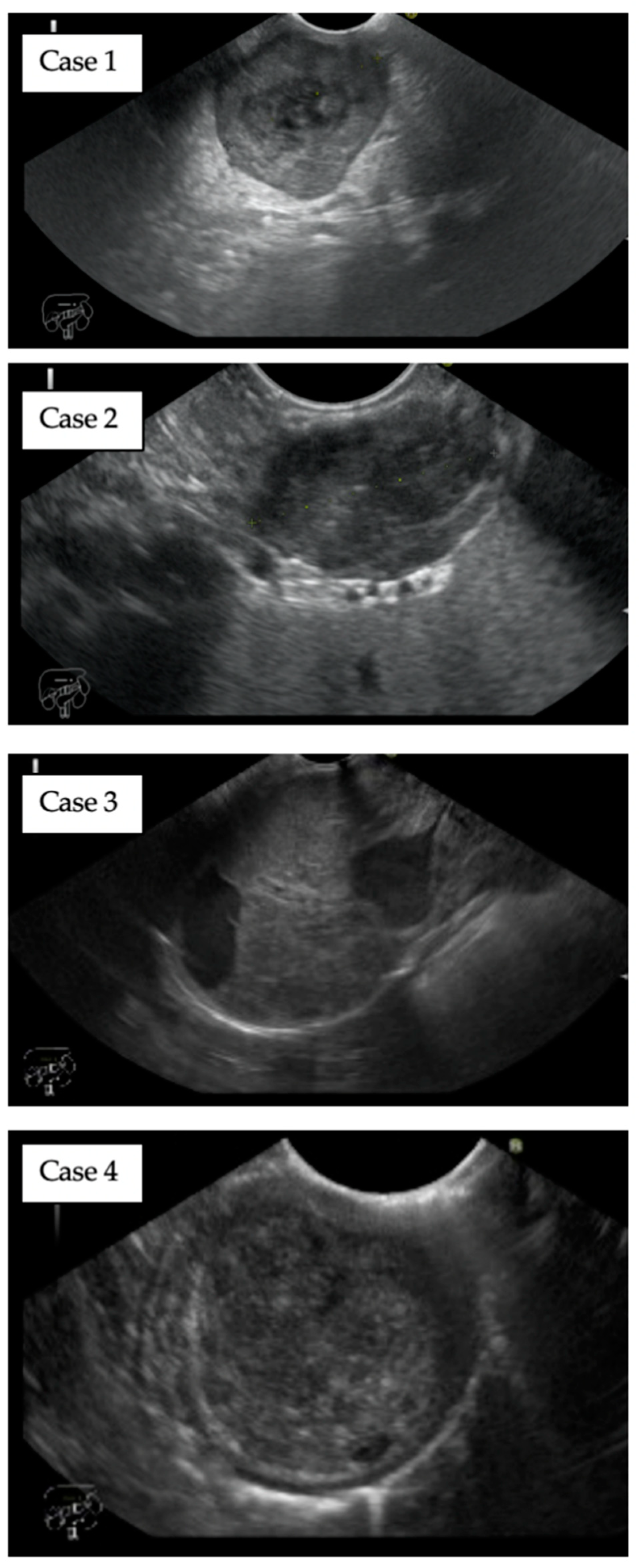JCM | Free Full-Text | Optimal Endoscopic Resection Technique for ...
